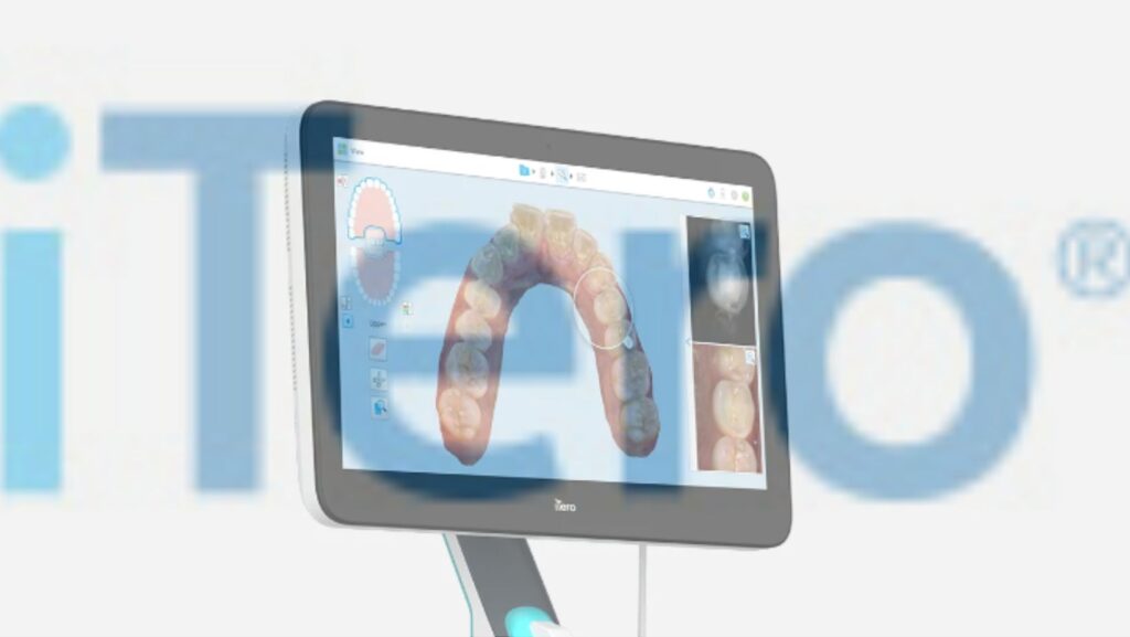 iTero Digital Impression System - Super Orthodontics, Dr. Amir Assefnia ...